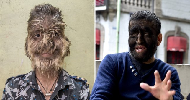 Spanish kids develop werewolf syndrome | RITZ